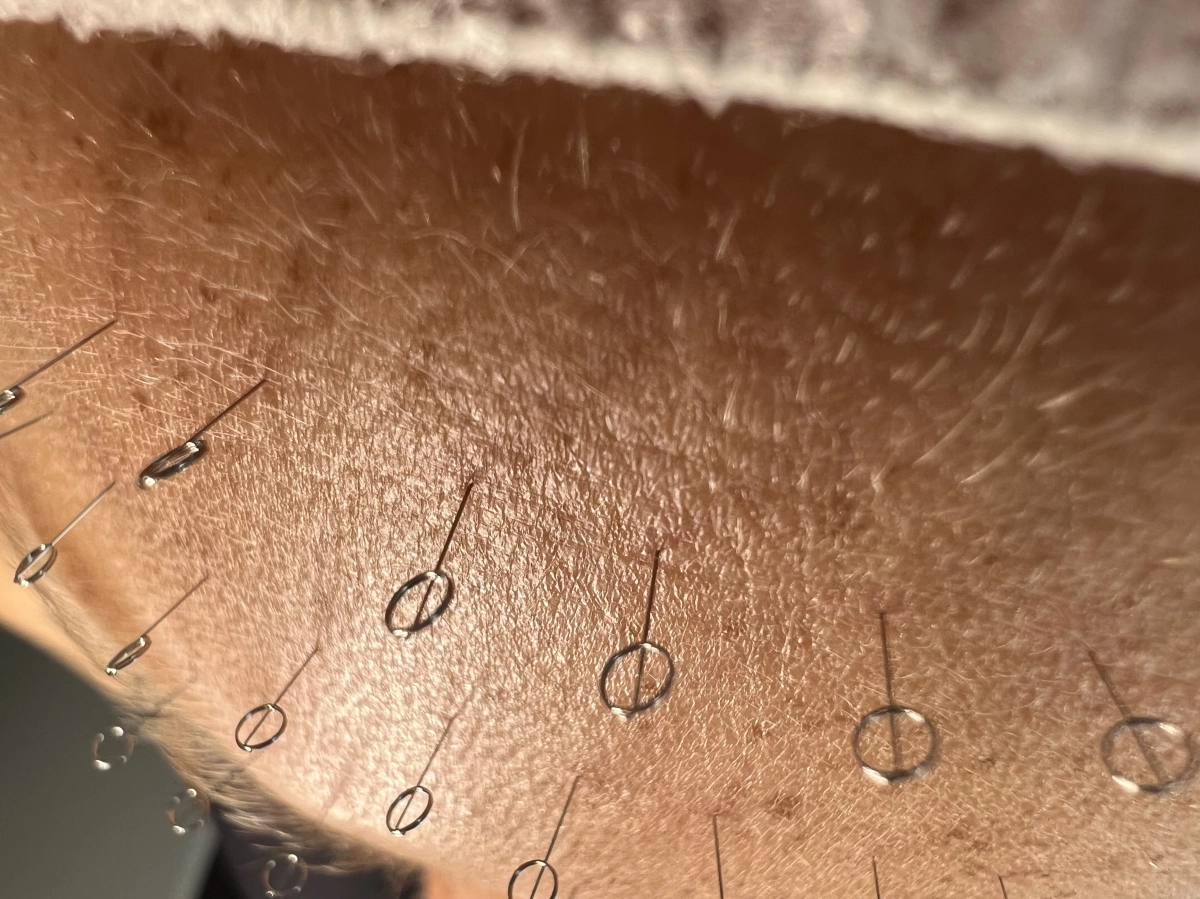 BEAUTY NEWS - Online Facial Intradermal Needling Course